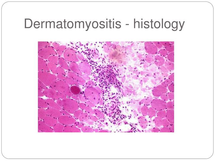 PPT - Inflammatory Myopathies PowerPoint Presentation - ID:1098681