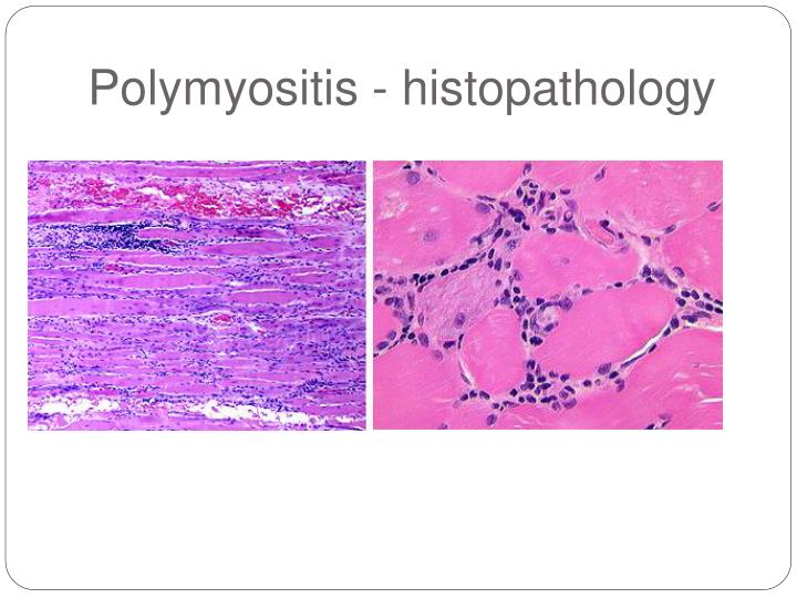 PPT - Inflammatory Myopathies PowerPoint Presentation - ID:1098681
