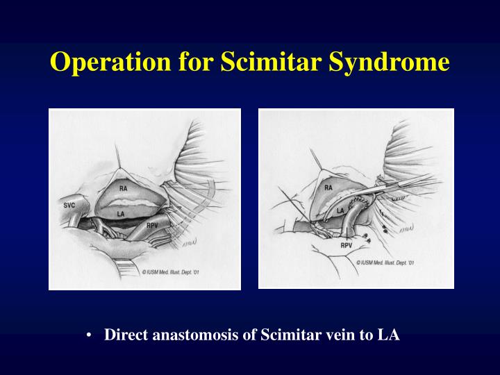 PPT - Atrial Septal Defect PowerPoint Presentation - ID:1108827