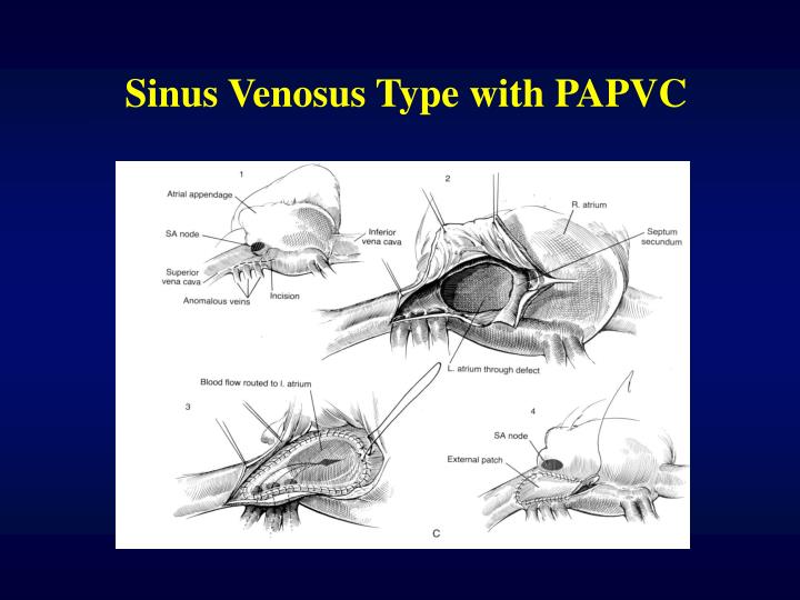 PPT - Atrial Septal Defect PowerPoint Presentation - ID:1108827