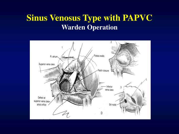 PPT - Atrial Septal Defect PowerPoint Presentation - ID:1108827
