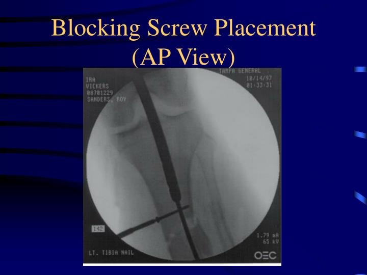 PPT - The Use of a Blocking Screw to Prevent Malalignment of Proximal ...