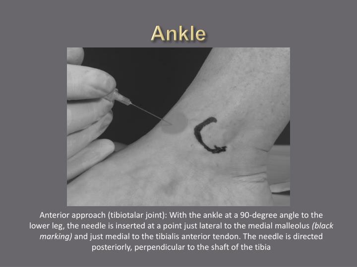 PPT - Arthrocentesis and Joint Injection for the Internist PowerPoint ...