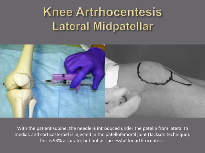 PPT - Arthrocentesis and Joint Injection for the Internist PowerPoint ...
