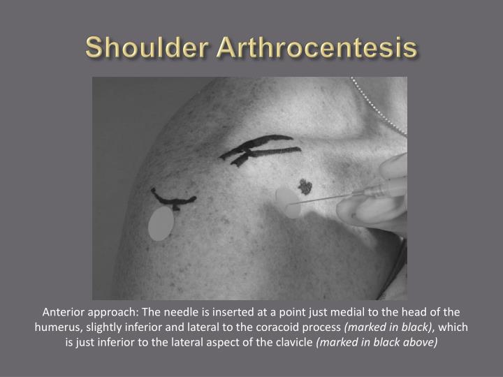 PPT - Arthrocentesis and Joint Injection for the Internist PowerPoint ...