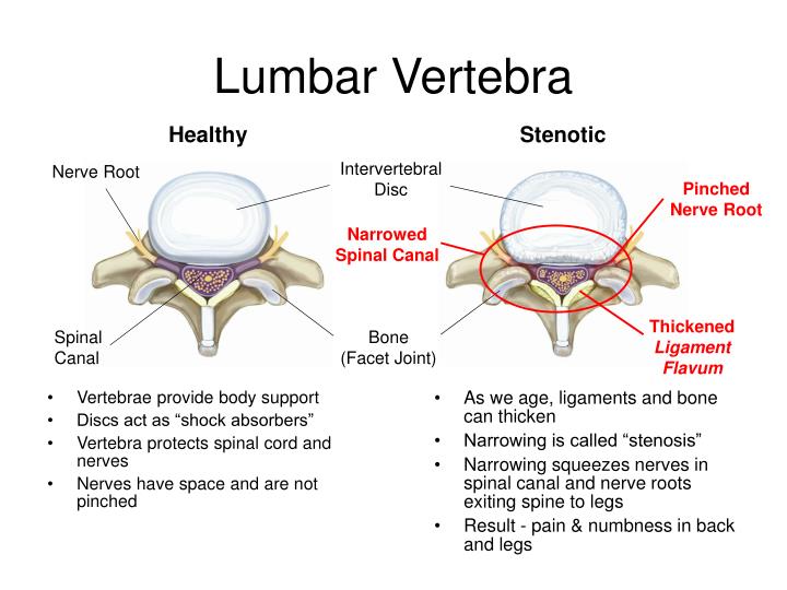 PPT - Lumbar Spinal Stenosis Symptoms and Treatment PowerPoint ...