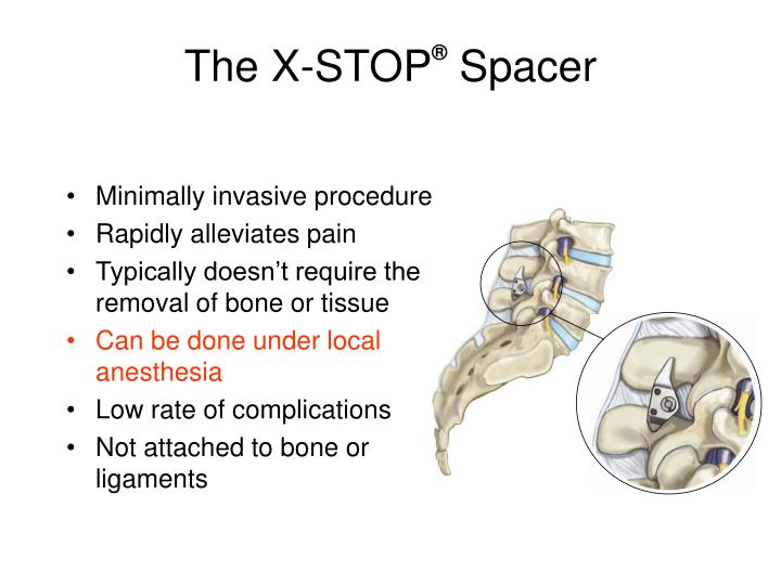 PPT - Lumbar Spinal Stenosis Symptoms and Treatment PowerPoint ...
