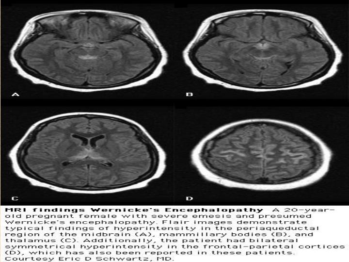 PPT - Wernicke-Korsakoff Syndrome: Neurological Effects of Chronic ...