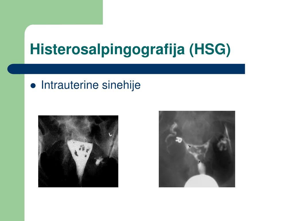 PPT - POUZDANOST RTG - HSG, sono - HSG I LAPAROSKOPIJE U OCJENI STANJA ...