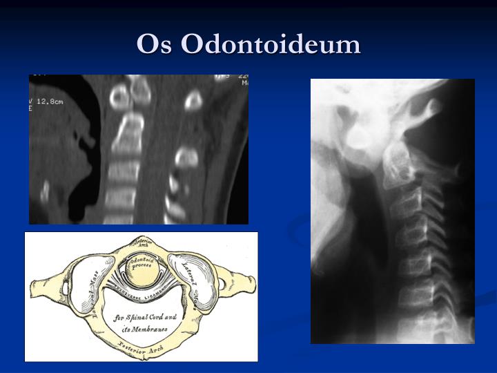 PPT - Pediatric C-Spine Trauma: Clearing the C-Spine PowerPoint ...