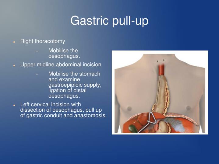 PPT - Colonic interposition for benign oesophageal disease. PowerPoint ...