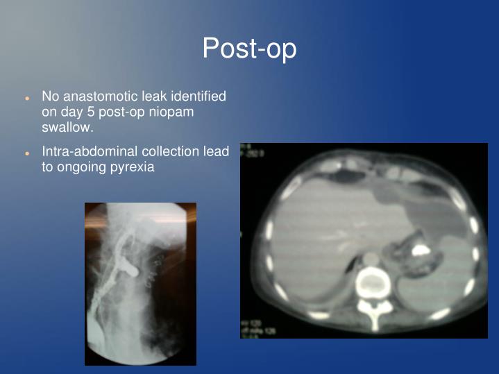 PPT - Colonic interposition for benign oesophageal disease. PowerPoint ...