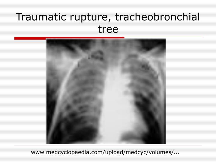 PPT - Thoracic Trauma PowerPoint Presentation - ID:1129649
