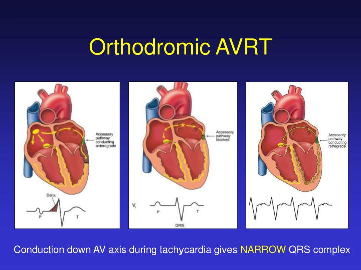 PPT - Supraventricular Arrhythmias PowerPoint Presentation - ID:1130049