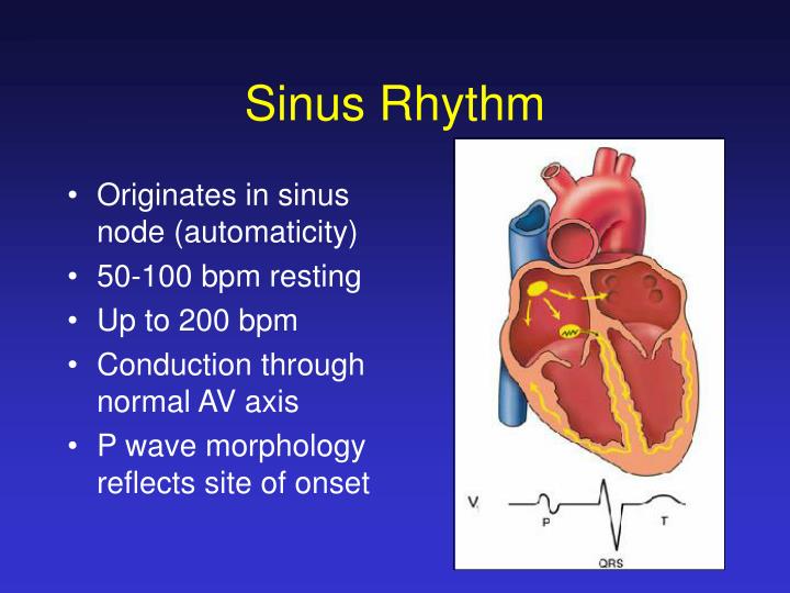 PPT - Supraventricular Arrhythmias PowerPoint Presentation - ID:1130049