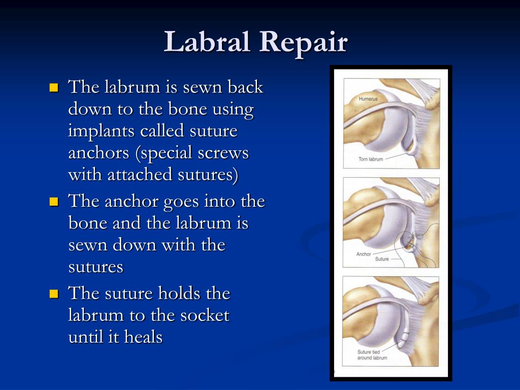 Ppt Arthroscopic Labral Surgery Powerpoint Presentation Free