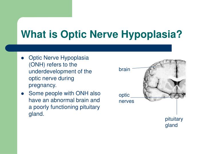 Ppt Optic Nerve Hypoplasia Powerpoint Presentation Id1134271