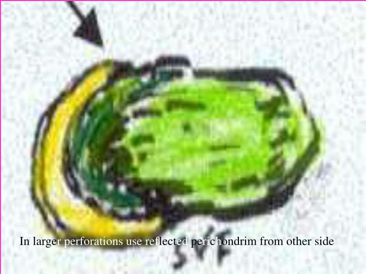 PPT - A simple technique to close subtotal perforations of the tympanic ...