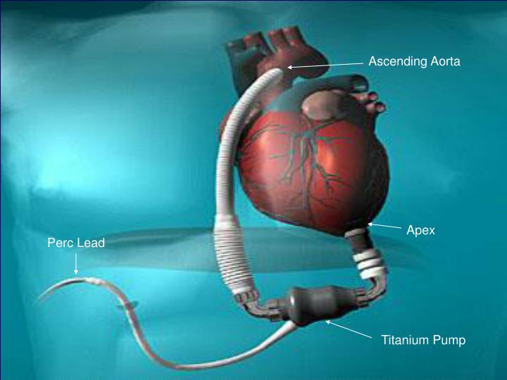 PPT - Left Ventricular Assist Devices “LVAD” PowerPoint Presentation ...