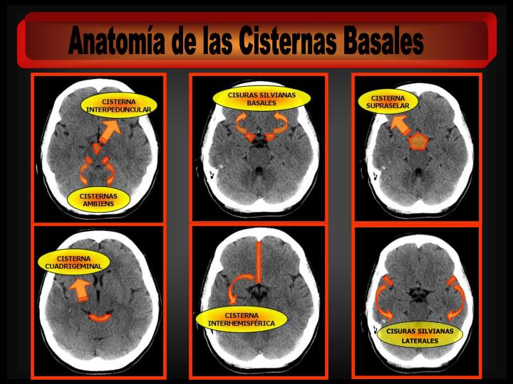 PPT - Aneurismas "INCIDENTALES" en el contexto de hemorragias ...