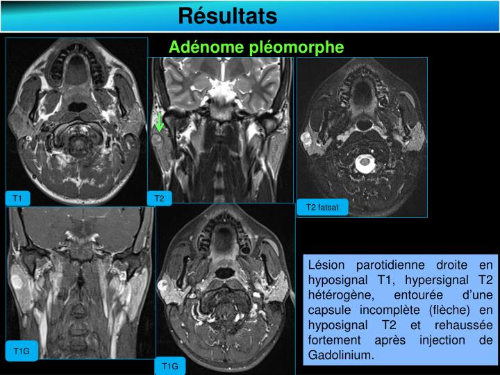 PPT - Aspect IRM des tumeurs bénignes de la parotide: à propos de 37 ...
