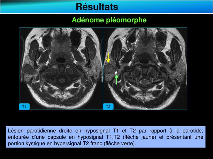 PPT - Aspect IRM des tumeurs bénignes de la parotide: à propos de 37 ...