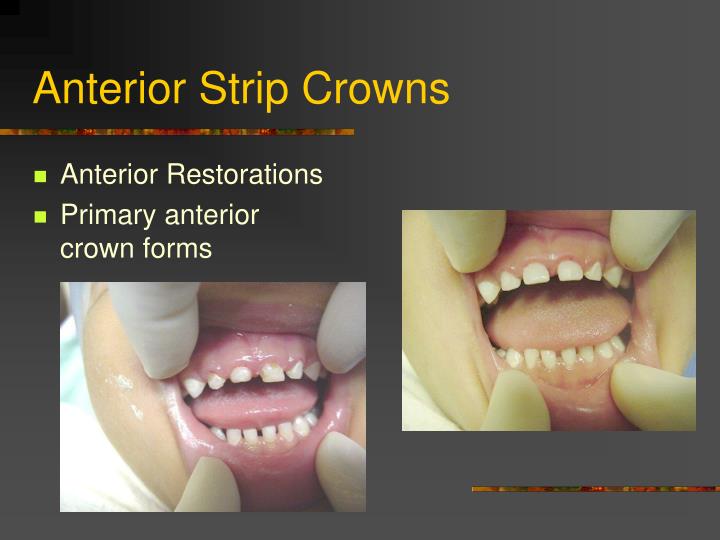 PPT - Dental Restorations in Pediatric Dentisty PowerPoint Presentation ...