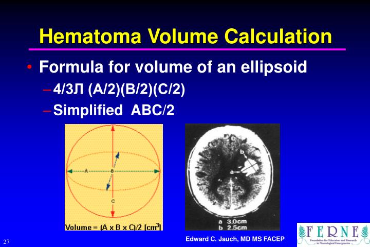 PPT - Epidemiology and Pathophysiology of Intracerebral Hemorrhage ...
