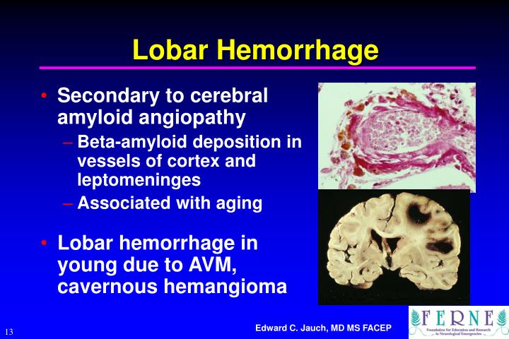PPT - Epidemiology and Pathophysiology of Intracerebral Hemorrhage ...