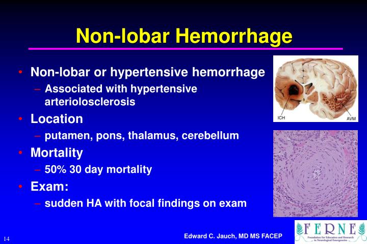 PPT - Epidemiology and Pathophysiology of Intracerebral Hemorrhage ...