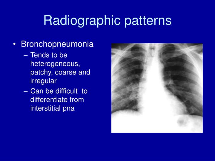 PPT - Infections PowerPoint Presentation - ID:1154485