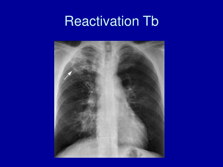 PPT - Infections PowerPoint Presentation - ID:1154485