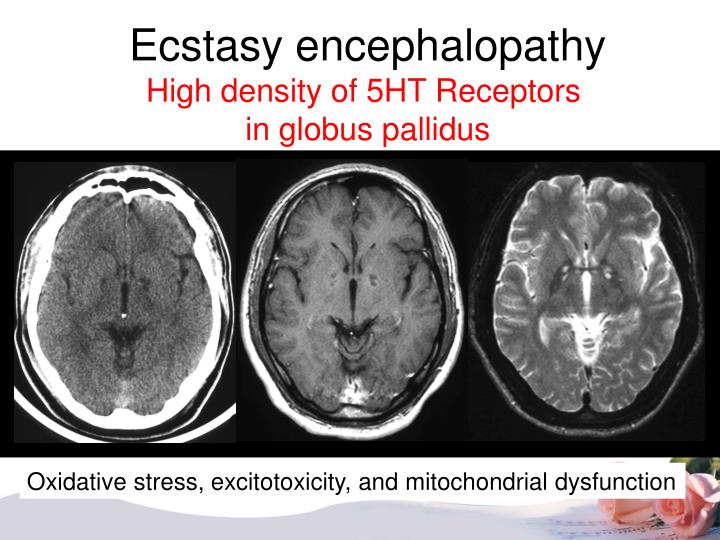 PPT - Neuroimaging of Toxic Encephalopathy PowerPoint Presentation - ID ...