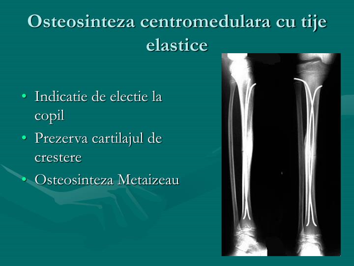 PPT - Fracturile membrului inferior PowerPoint Presentation - ID:1169097