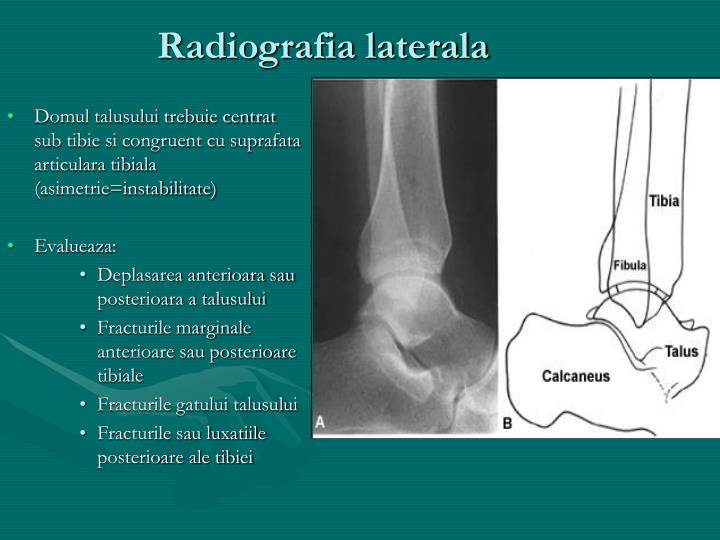 PPT - Fracturile membrului inferior PowerPoint Presentation - ID:1169097