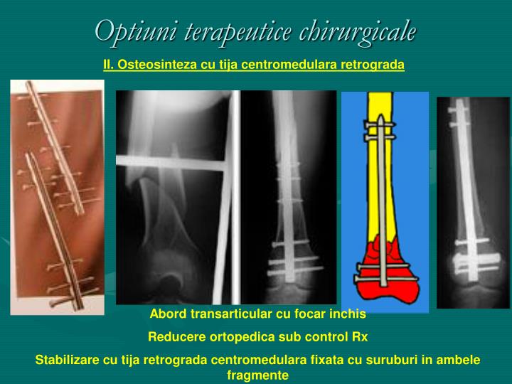 PPT - Fracturile membrului inferior PowerPoint Presentation - ID:1169097