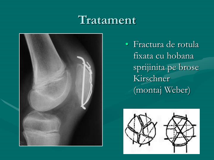 PPT - Fracturile membrului inferior PowerPoint Presentation - ID:1169097
