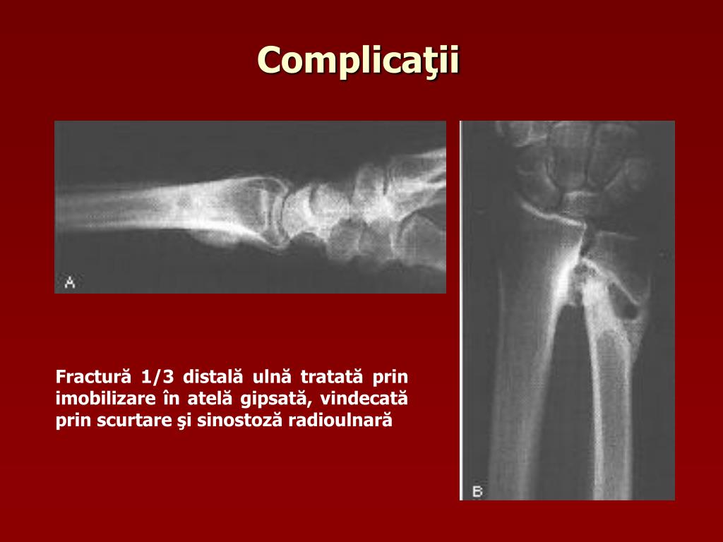 PPT - Fracturile diafizei oaselor antebraţului la adult PowerPoint ...