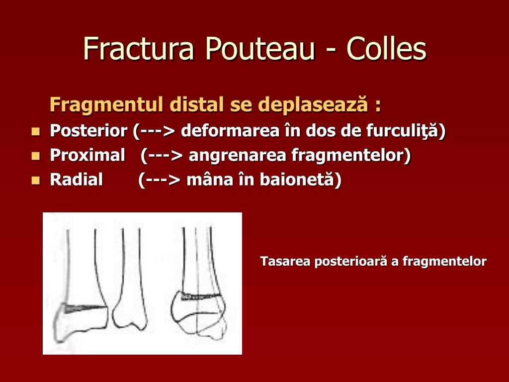 PPT - Fracturile diafizei oaselor antebraţului la adult PowerPoint ...