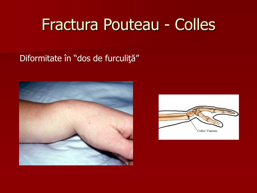 PPT - Fracturile diafizei oaselor antebraţului la adult PowerPoint ...