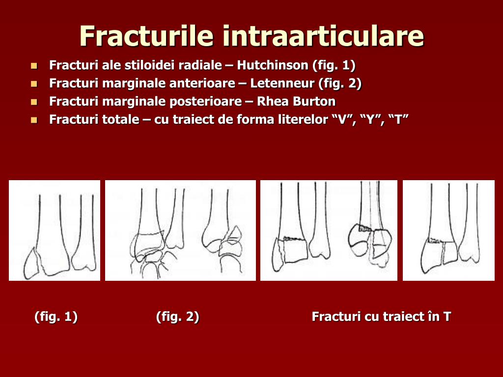 PPT - Fracturile diafizei oaselor antebraţului la adult PowerPoint ...