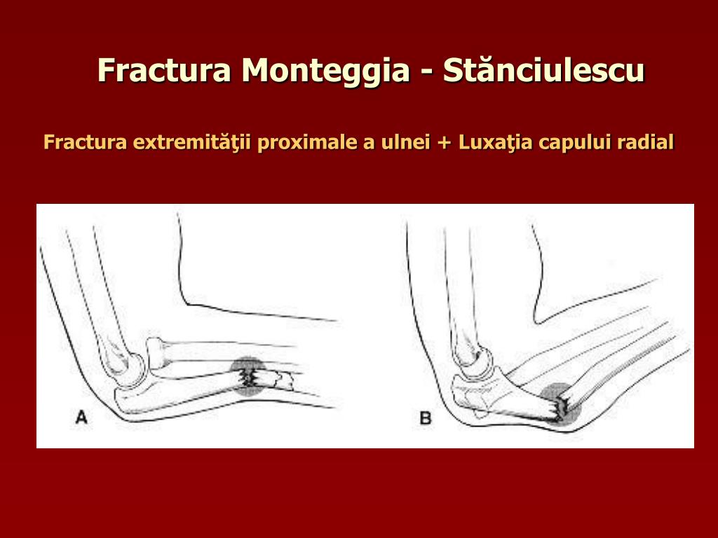 PPT - Fracturile diafizei oaselor antebraţului la adult PowerPoint ...