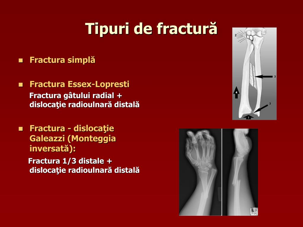 PPT - Fracturile diafizei oaselor antebraţului la adult PowerPoint ...