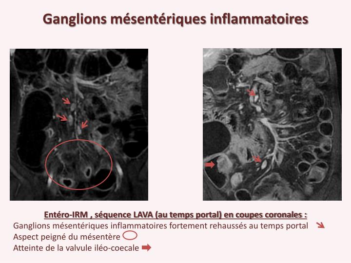 PPT - L INTÉRÊT DE L ENTÉRO-IRM DANS LE DIAGNOSTIC ET LE BILAN DE LA ...