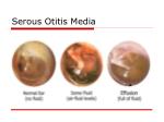 PPT - Childhood Otitis Media PowerPoint Presentation - ID:1181396