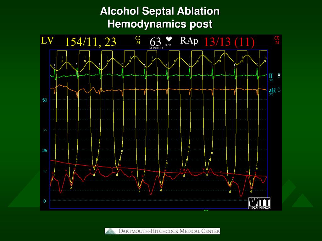PPT - Alcohol Septal Ablation in Hypertrophic Obstructive ...
