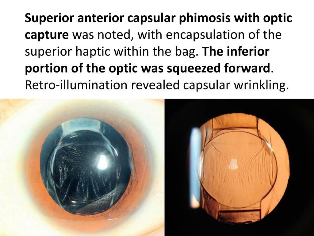 PPT - Severe Z Syndrome with the Plate-Haptic Silicone Hinged ...