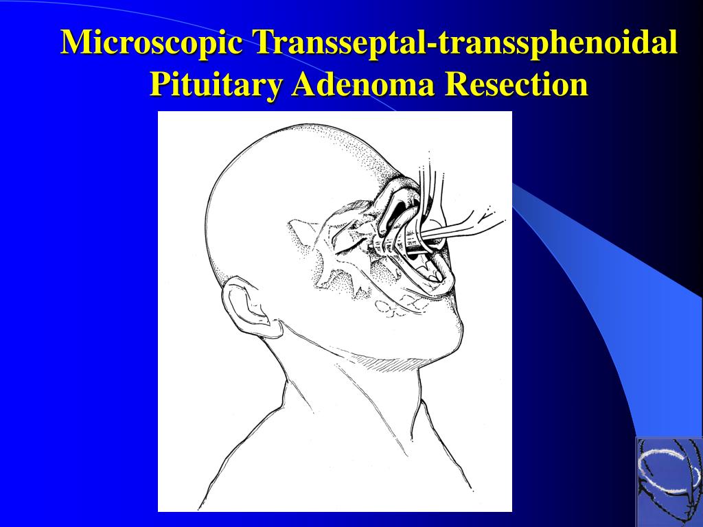 Ppt From An Open Transcranial To A Minimally Invasive Endoscopic