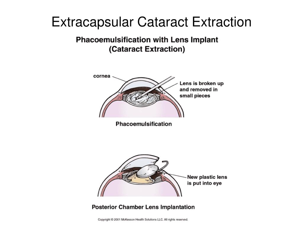 PPT - Intraocular Lenses & Cataract Removal PowerPoint Presentation ... PPT - Intraocular Lenses & Cataract Removal PowerPoint Presentation ...