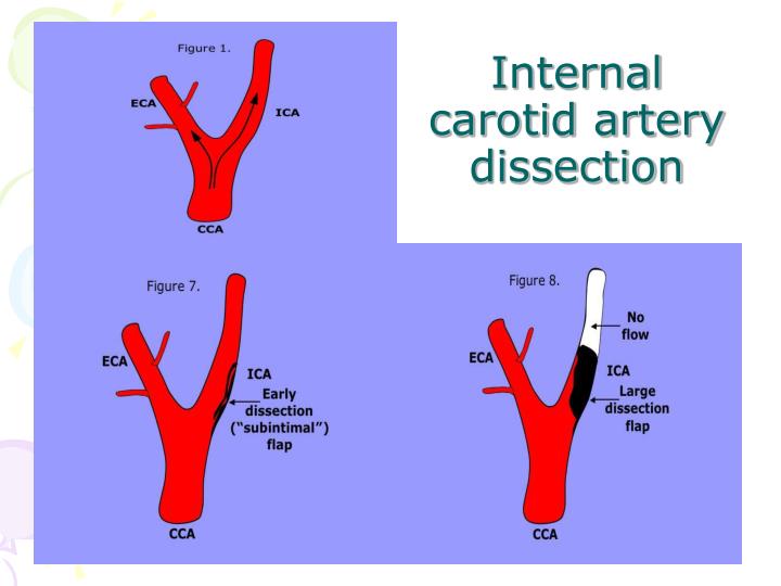 PPT - STROKE IN THE YOUNG PowerPoint Presentation - ID:1189788